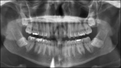 Wisdom Teeth Removal - Anacapa Oral Surgery Dental Implant Center