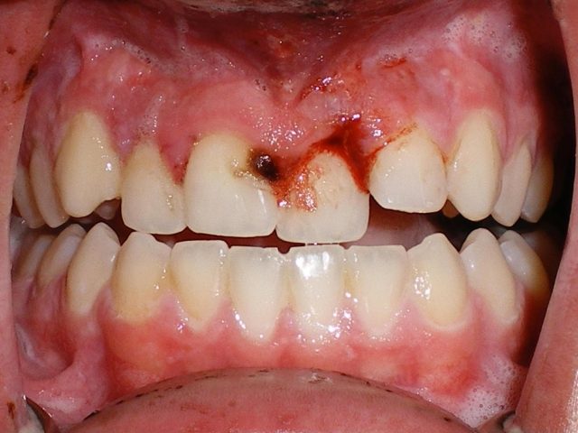Dental & Facial Trauma - Anacapa Oral Surgery Dental Implant Center