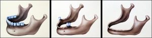 Reconstructive Jaw Surgery - Anacapa Oral Surgery Dental Implant Center